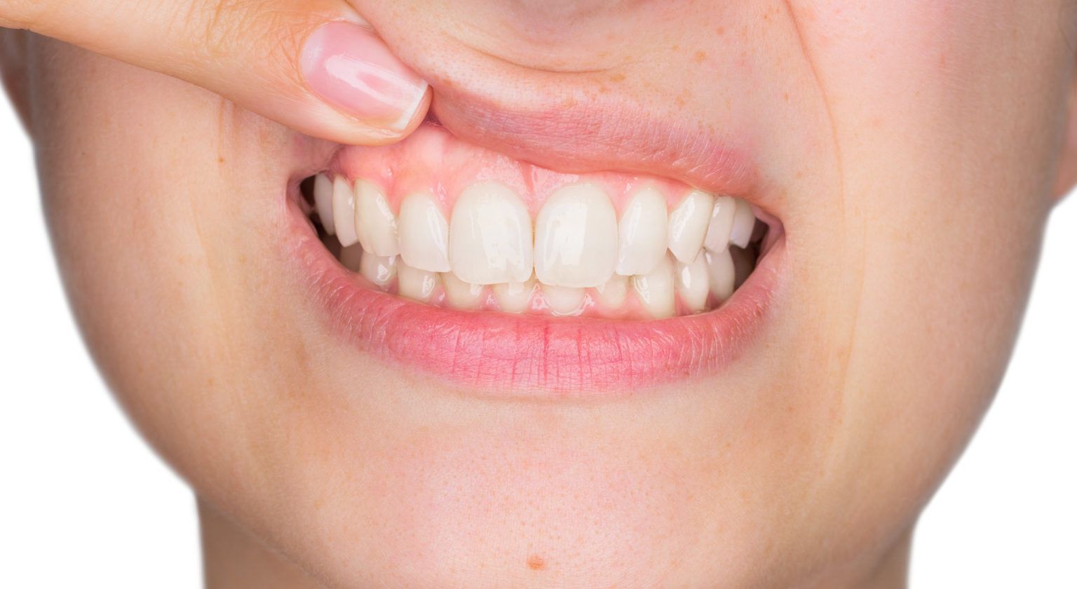 Gingivectomie et traitement des gencives à Paris par chirurgie | Dr Cohen