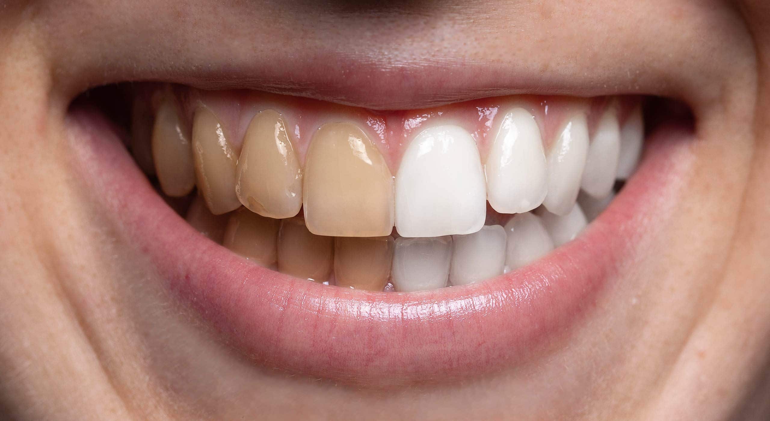 Blanchir Ses Dents Paris 8 Chez Un Chirurgien Dentaire Dr Cohen